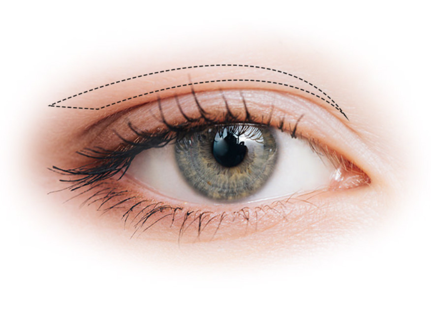Blepharoplasty (Eyelid Surgery) in Montreal | Eyelid Lift Specialist Dr ...
